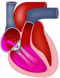 The DUO™ System - CroiValve